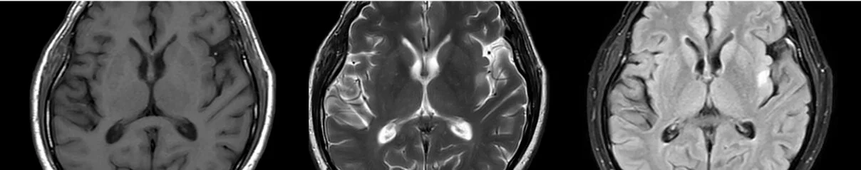 Frontotemporal Dementia (FTD) - SPARC